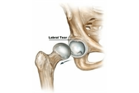 Labral Tear Hip Treatment Dwarka, Delhi | Pain Free Physiotherapy