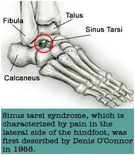 Sinus Tarsi Syndrome Treatment in Dwarka | Pain Free Physiotherapy